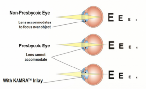 KAMRA Inlay Corona | Near Vision Correction Rancho Cucamonga