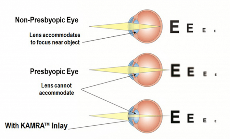 KAMRA Inlay Corona | Near Vision Correction Rancho Cucamonga
